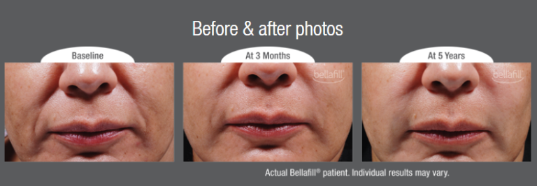 BellaFill® Southampton | Bucks County PA BellaFill® Injections